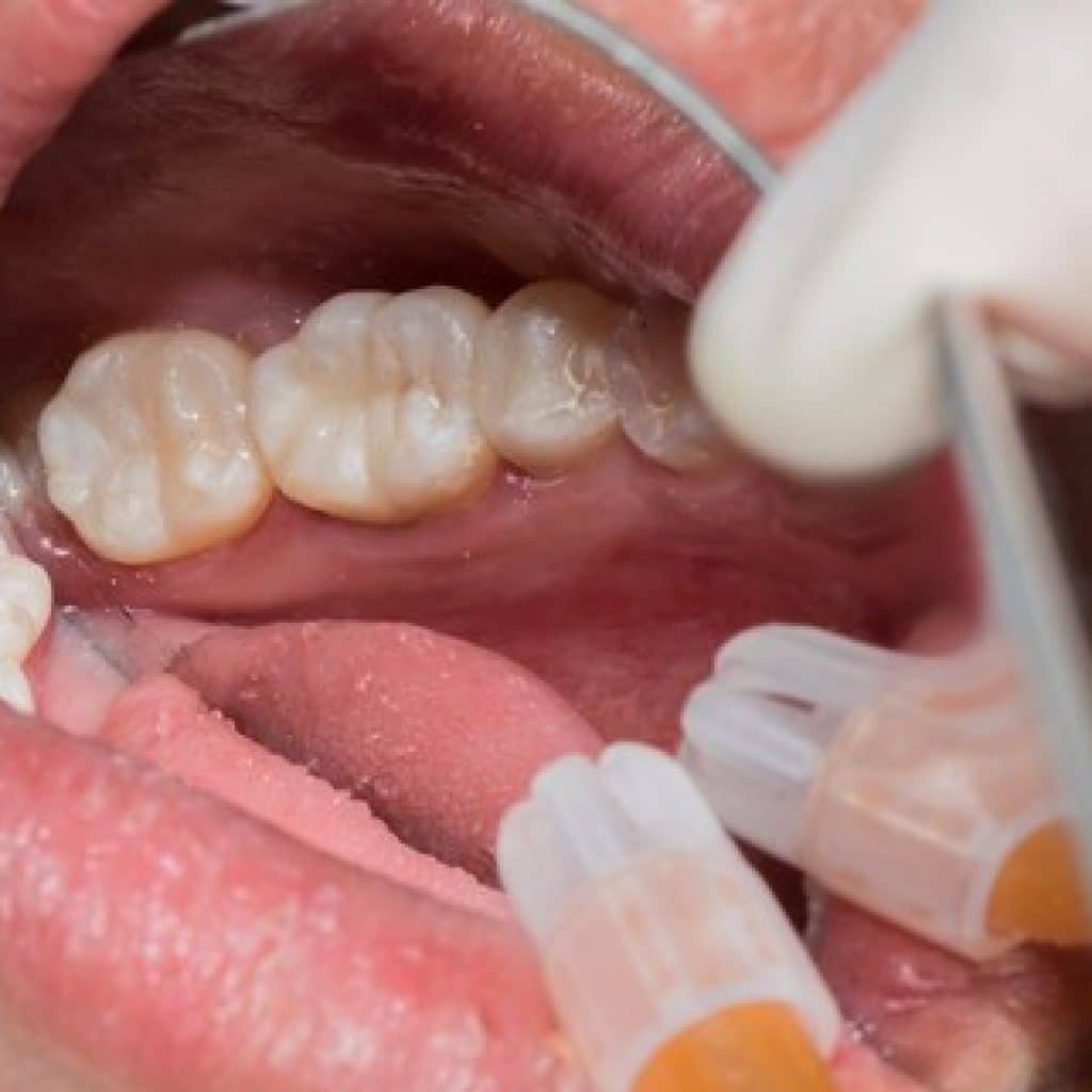 Apexification Therapy | Root Canal Specialist | Buffalo Endodontist